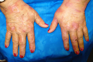VIRTUAL GRAND ROUNDS IN DERMATOLOGY 2.0: Hand Bullae in the Setting of ...