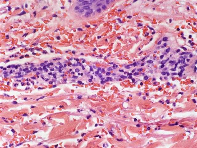 VIRTUAL GRAND ROUNDS IN DERMATOLOGY 2.0: 35 yo woman with short history ...