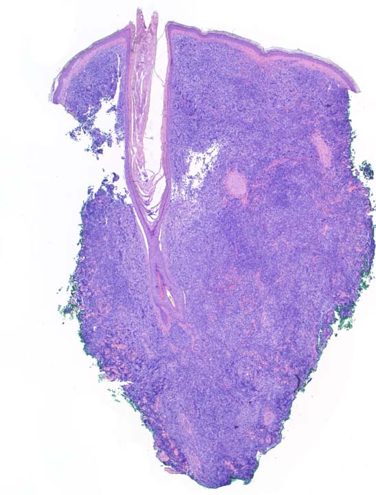VIRTUAL GRAND ROUNDS IN DERMATOLOGY 2.0: Atypical Lymphocytic Infiltrate