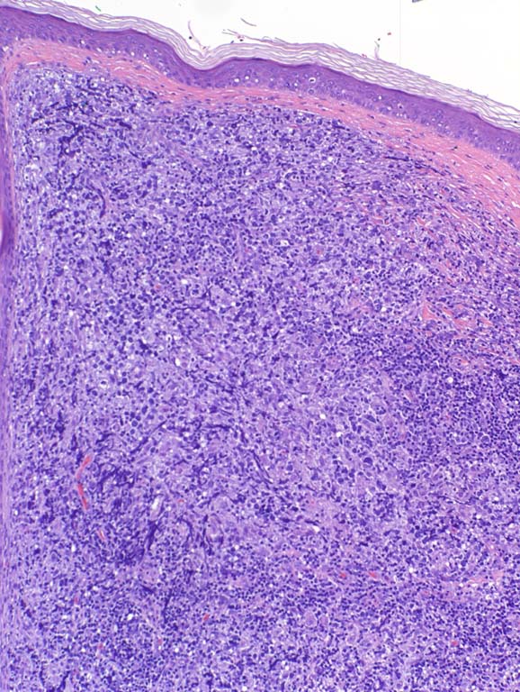 VIRTUAL GRAND ROUNDS IN DERMATOLOGY 2.0: Atypical Lymphocytic Infiltrate