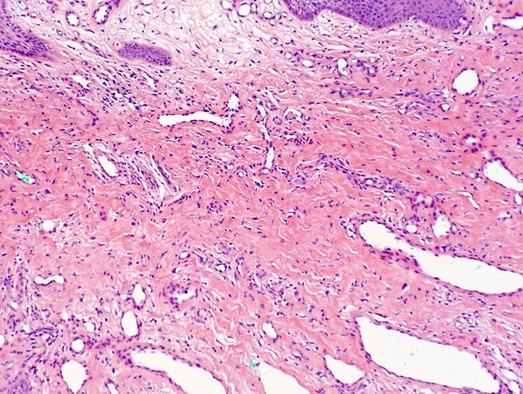 VIRTUAL GRAND ROUNDS IN DERMATOLOGY 2.0: Unusual Nail Bed Tumor