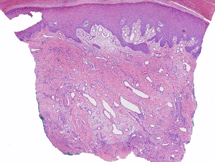VIRTUAL GRAND ROUNDS IN DERMATOLOGY 2.0: Unusual Nail Bed Tumor