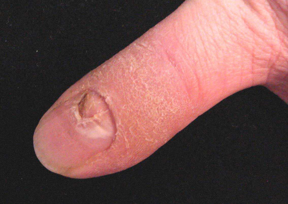 VIRTUAL GRAND ROUNDS IN DERMATOLOGY 2.0: Unusual Nail Bed Tumor
