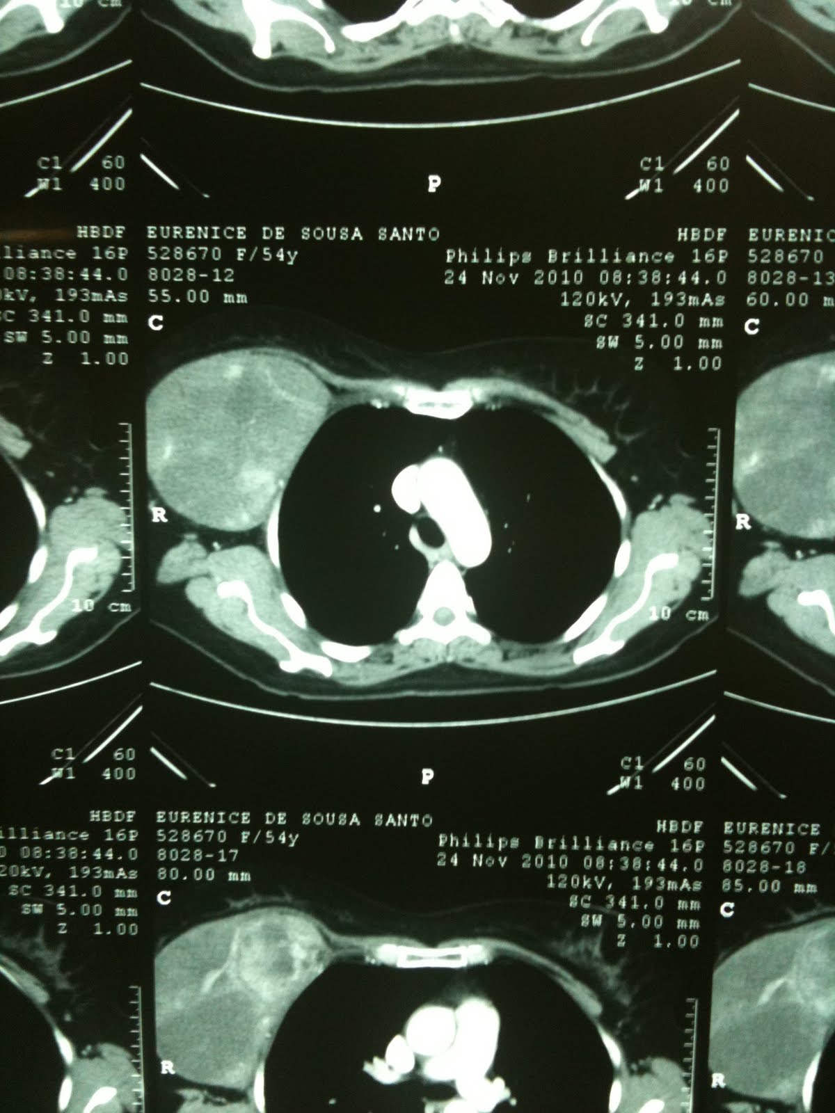 Imagens Cirurgia: Tumor de parede torácica tomografia