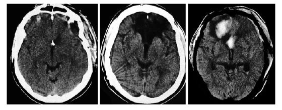 Jamie's Social Neuroscience Blog: Brain Lesion and Empathy