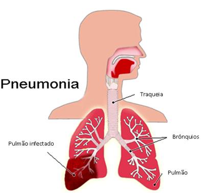 SOSaúde: Pneumonia