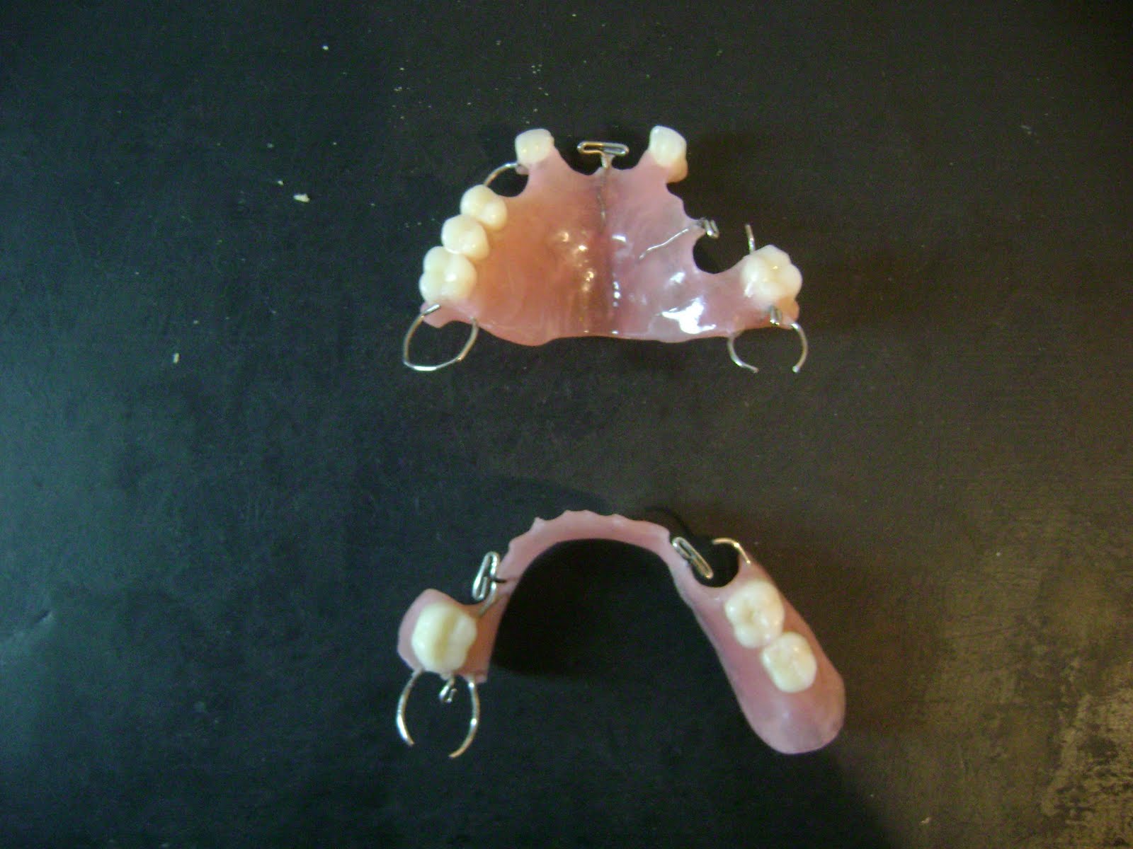 Laboratorio Dental Fernando Emmanueli: Protesís Parcial Removible