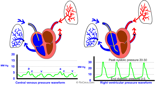 learn anesthesia and have fun: PULMONARY ARTERY PRESSURE MONITORING