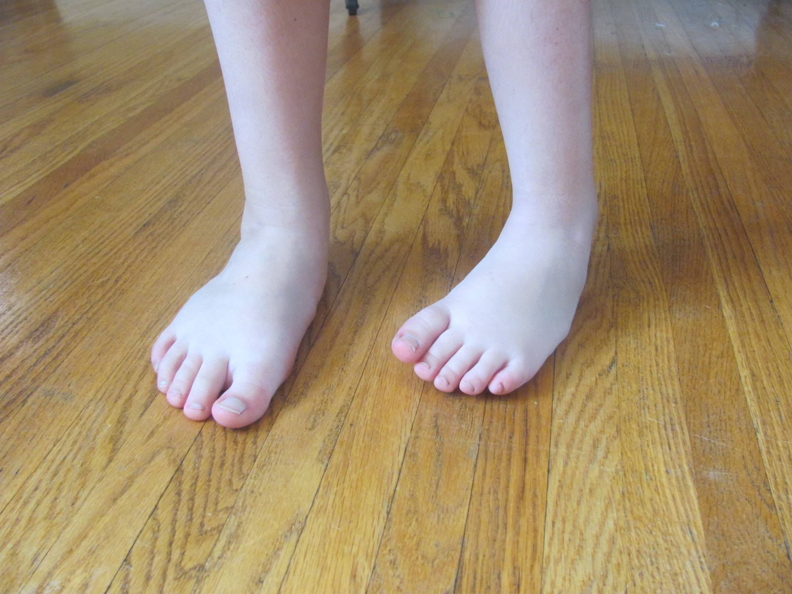 Kate's Blog: Some Pictures of Cassie's left foot the day before surgery
