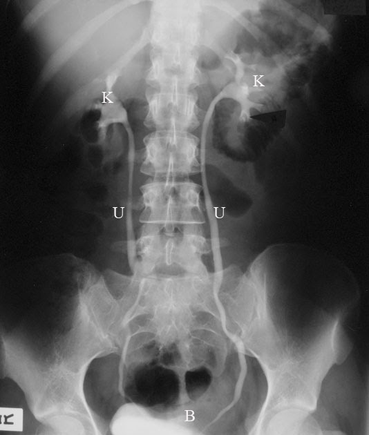 Rock 'N' Roll Hideaway: VCUG Test