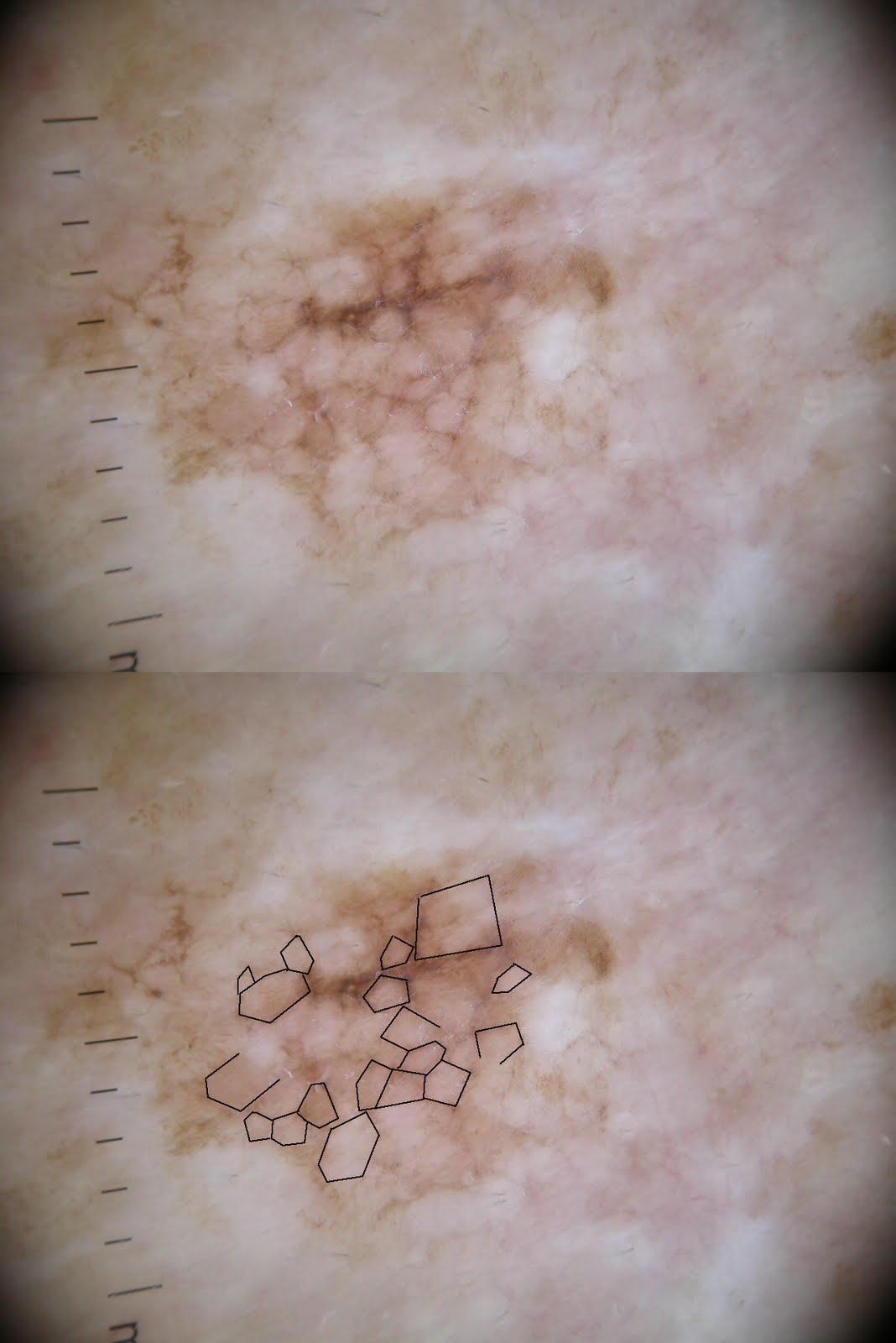 POLYGONS - Author: Jeff Keir: Polygons in Dermatoscopy - Original ...